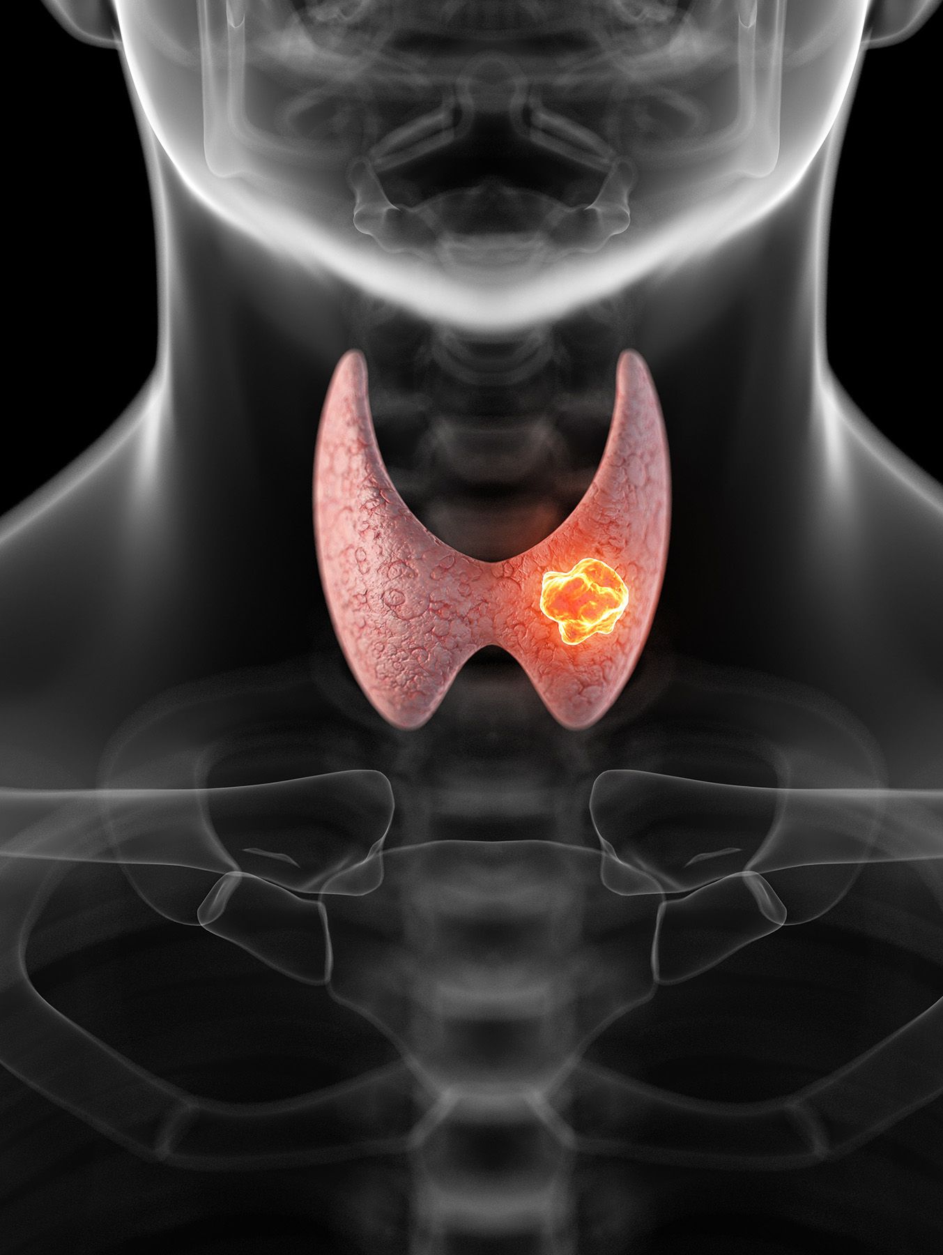 Lumps and Bumps in - Image 6 from You and Your Thyroid: What You Need ...