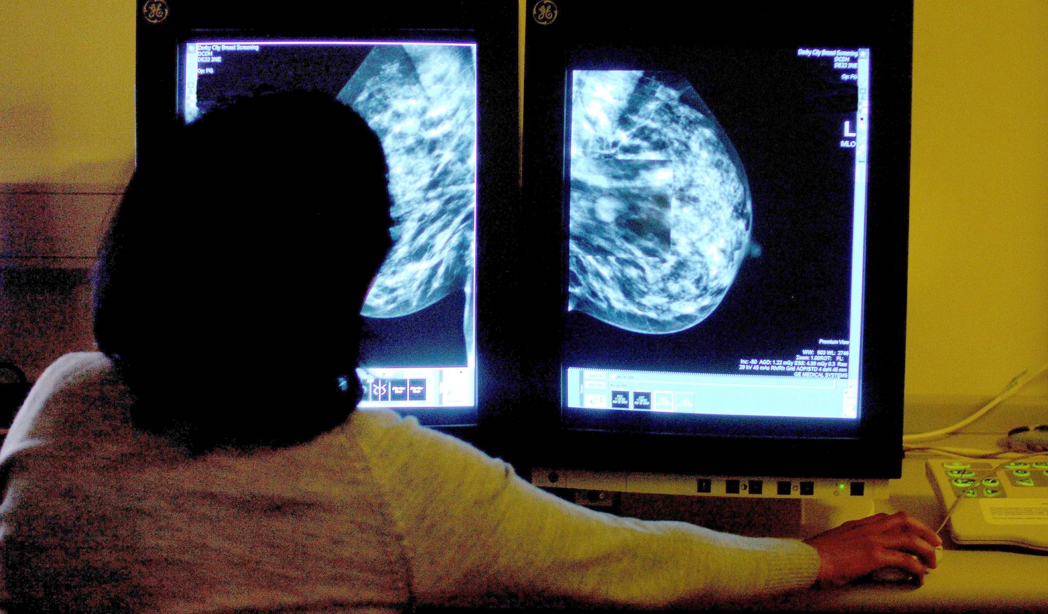 What Black Women Need to Know About Mammograms | News | BET