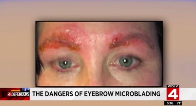 Woman's Horrific 'Microblading' Experience Led To A Costly Infection ...