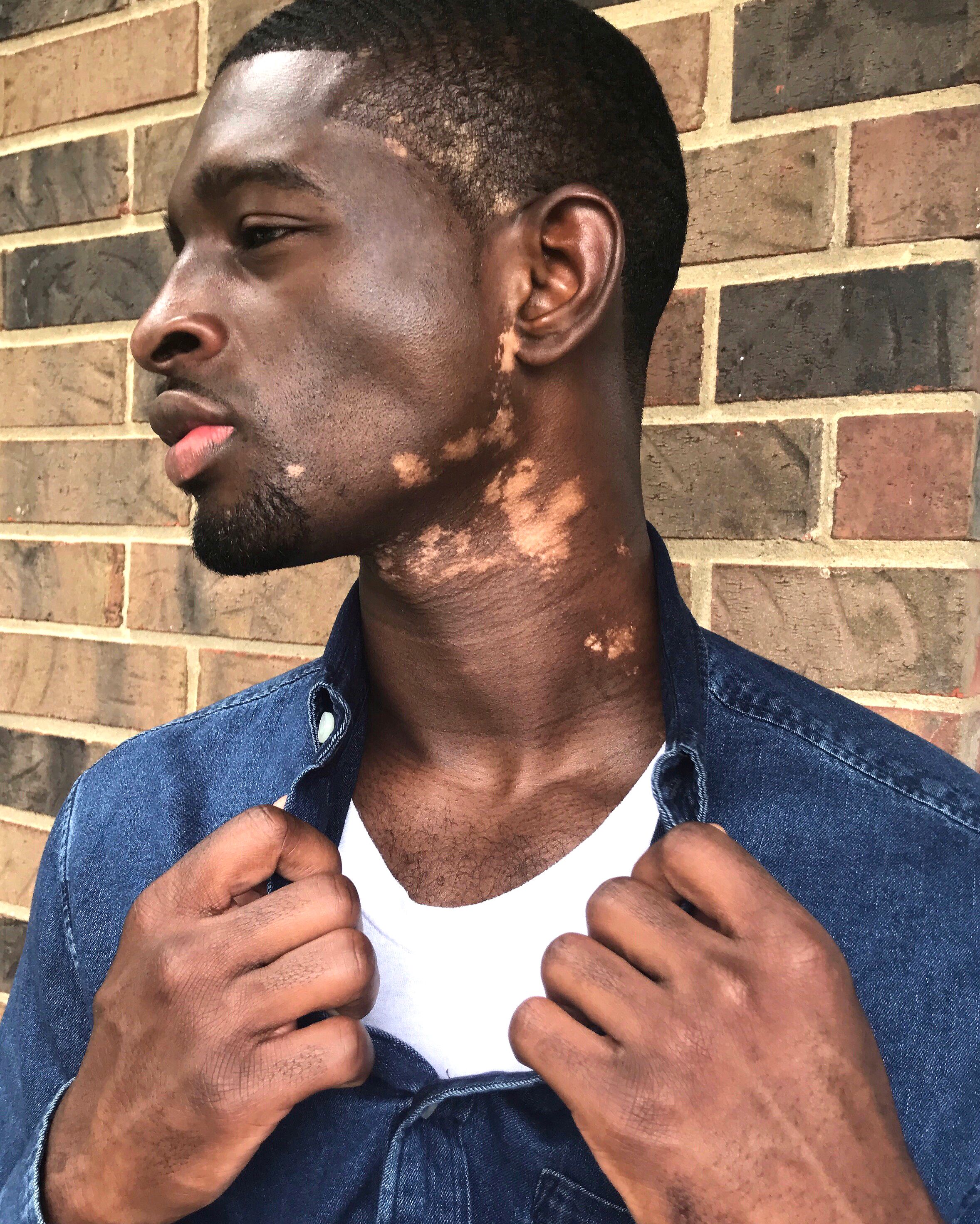 This Male Model Got Vitiligo in the Middle of His Career and He's Still ...