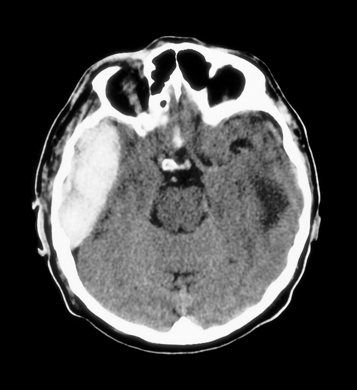 What CTE Does to - Image 3 from CTE on the Brain | BET