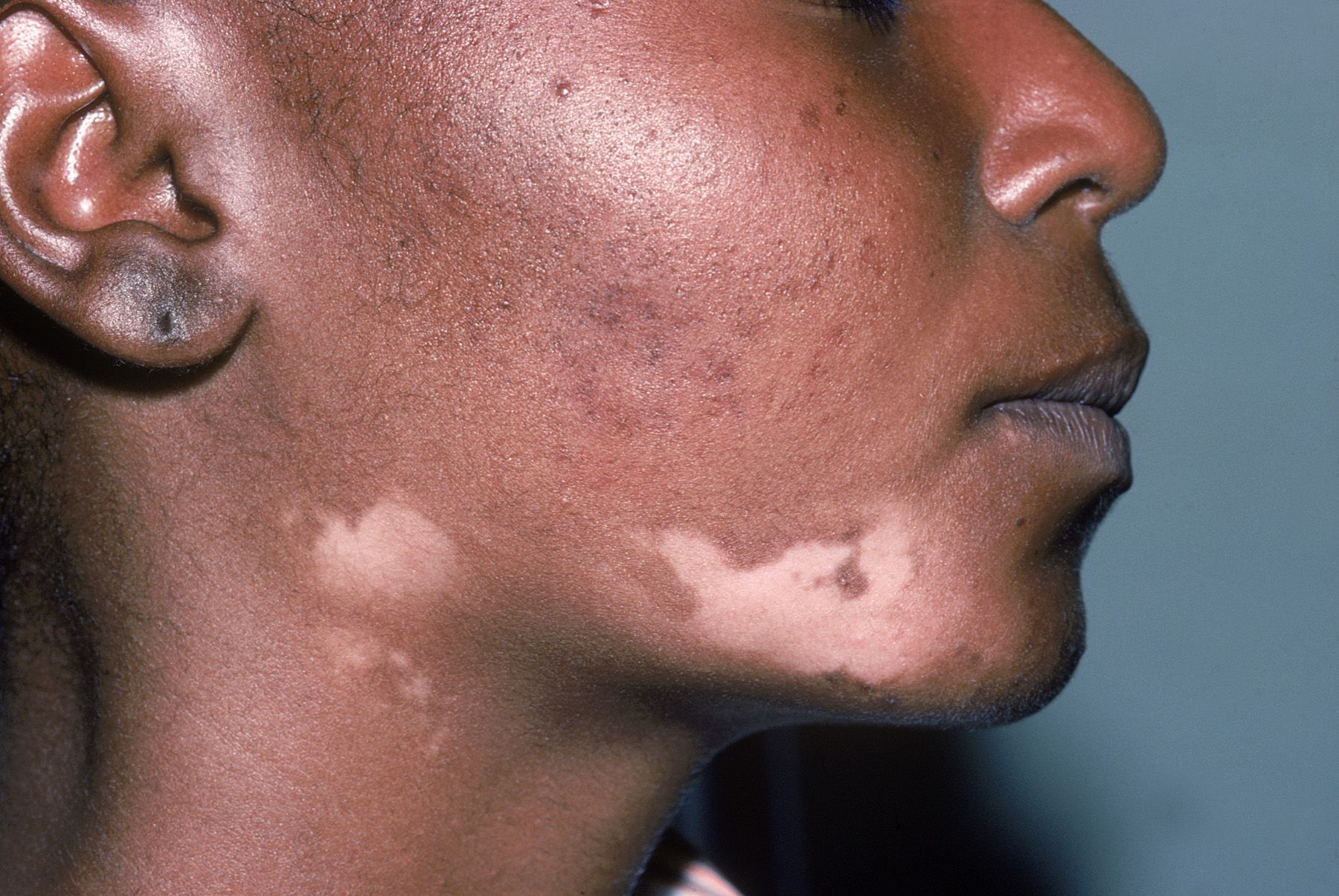 It May Be in - Image 7 from The 411 on Vitiligo | BET